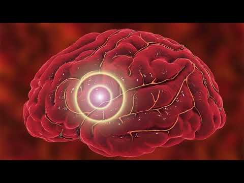 What Are The 3 Types Of Strokes And Their Symptoms? Which Is The Most Serious?