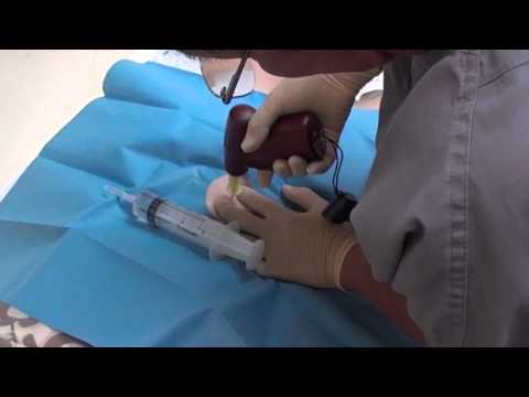 BMA / Bone Marrow Aspirate for Orthopedic's and Regeneration for Knee, shoulder, hip