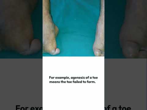 What is agenesis? #medicaleducation #shorts