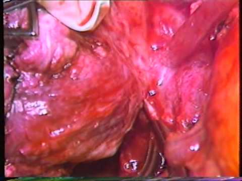 1996, Duodenum-preserving panceatectomy