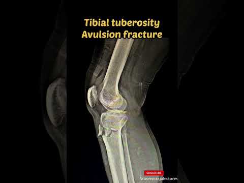 Avulsion fracture || Tibial Tuberosity