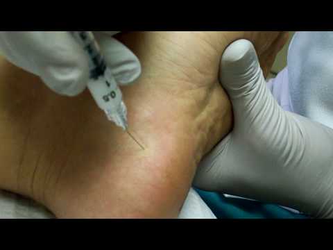 Infiltration d’une aponévrosite (fasciite) plantaire (cabinet ...