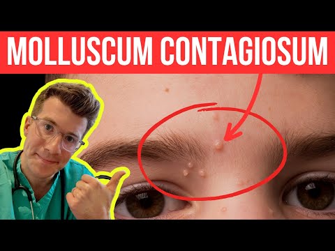 Doctor explains Molloscum Contagiosum (viral skin infection) | Causes, symptoms and treatment