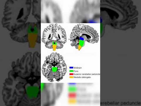 The Stroke - Brain stem stroke...