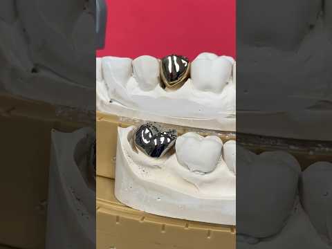Full Cast Molar Crowns!