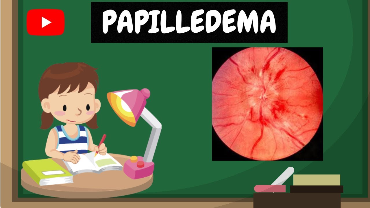Papilledema | Learn with Neha
