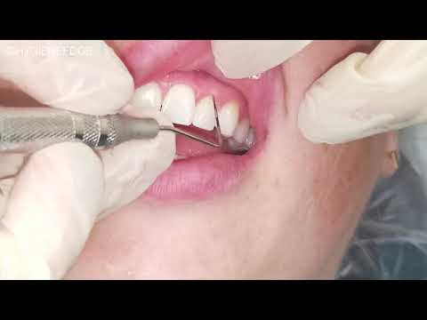 Explaining Probe Depths to Patients