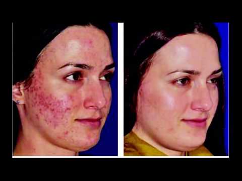 What is PRP?