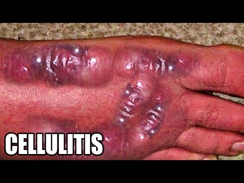 Cellulitis! What is it? Treatment of Cellulitis