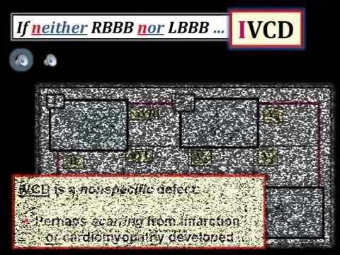 ECG Video-2 (Blog 96) - BBB (8-30.1-2014)
