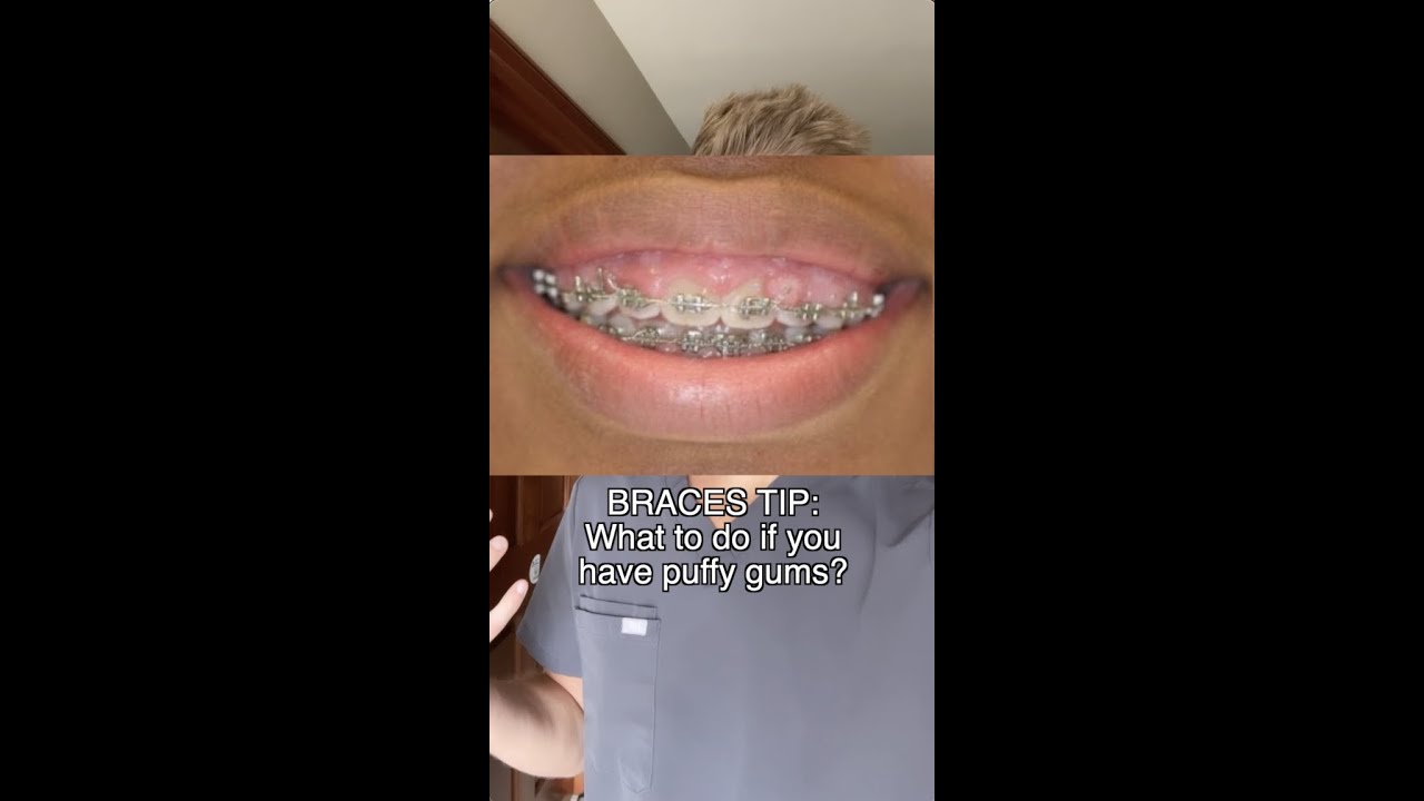 HELP!!! My Gums Are Puffy From My Braces! 😩 What Should I Do?!?