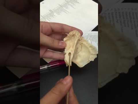 Temporal Bone - Valle Anatomy 32