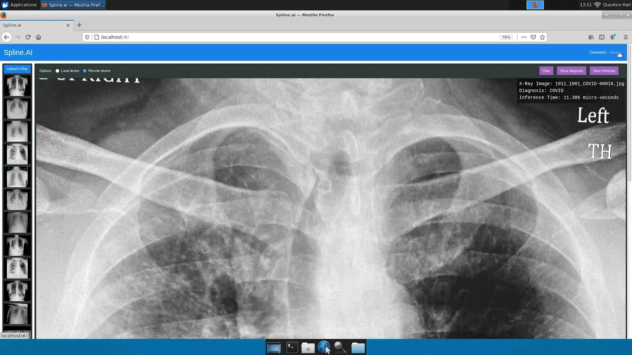 Xilinx Demonstration of an X-ray Classification Solution for COVID-19 and Pneumonia Detection