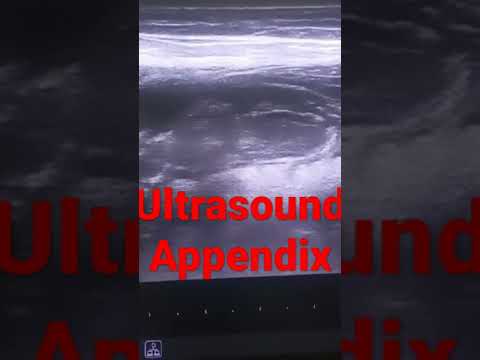 Appendix Ultrasound | Acute Appendicitis