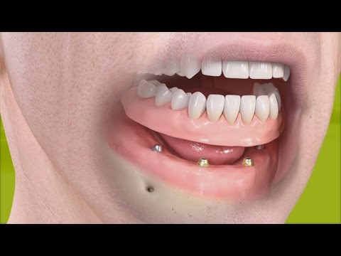Straumann - Restauration fixe à l'aide de 4 implants, latéraux inclinés