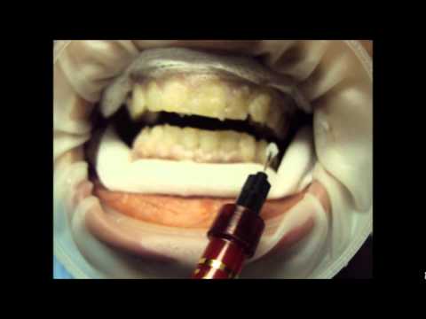 laser whitening at arizona dental- May, 2012
