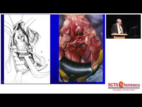 Superior sulcus tumour resection