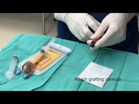 Demonstration of PUREGRAFT and PUREGRAFT Boost by Dr. Guy Cappuccino
