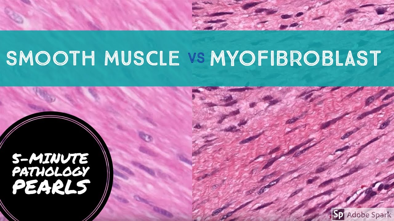 Myofibroblasts vs Smooth Muscle Made Easy: 5-Minute Pathology Pearls
