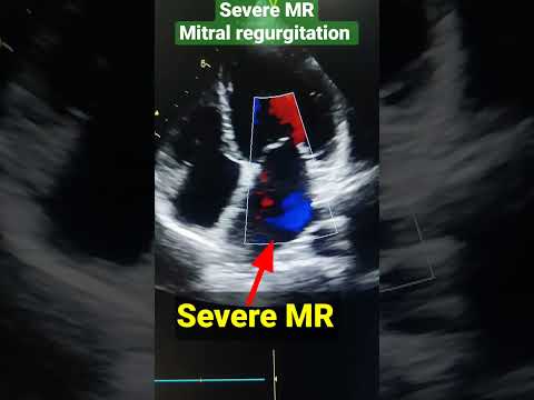 Severe MR ( mitral regurgitation) in Echocardiography #shorts #echo