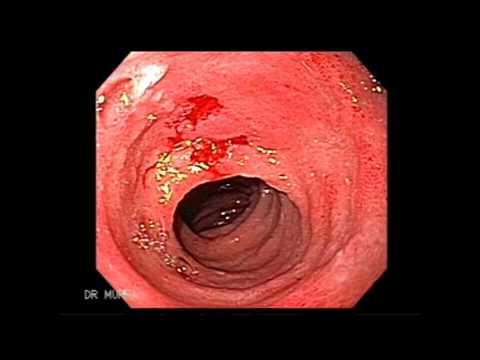 Endoscopy of Celiac Disease