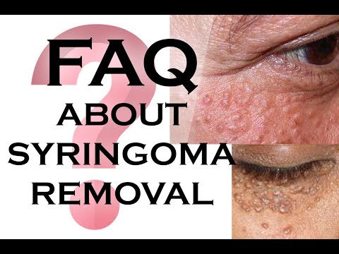 FAQ - ABOUT SYRINGOMA REMOVAL