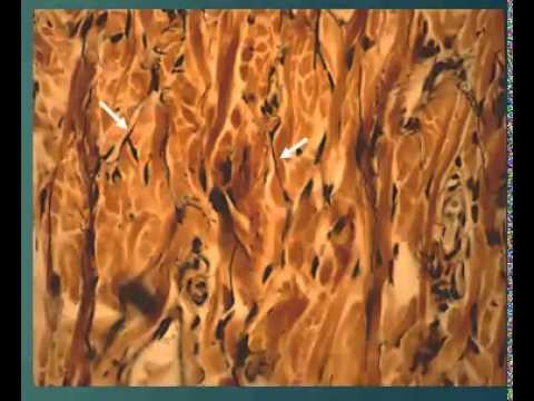 Dense irregular connective tissue, elastic fibers