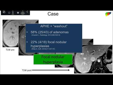 46. Liver malignancy masquerading as benignancy and how LI-RADS fits in-Part 1. By Dr. William Masch