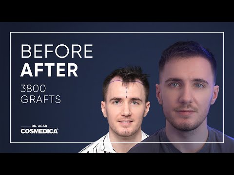 Hair Transplant in Turkey | Results | Dr. Acar | Cosmedica Clinic