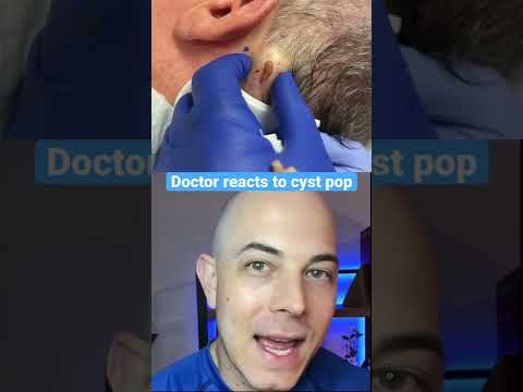 AMAZING Cyst Pop! | 208SkinDoc