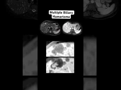 Multiple biliary hamartomas (Von Meyenburg Complexes)