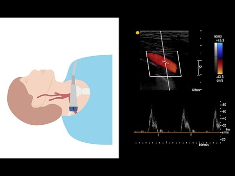 Scanning the extracranial arteries with ultrasound