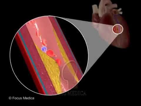 Acute coronary syndrome