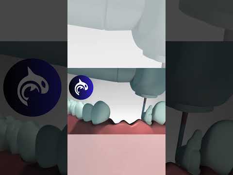 See how a Dental Bridge is done in 3D. #dentist #dentalhealth #teeth