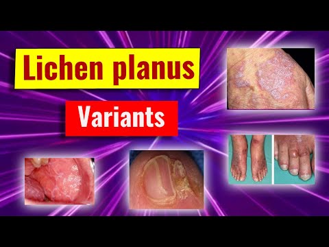 Clinical variants of lichen planus