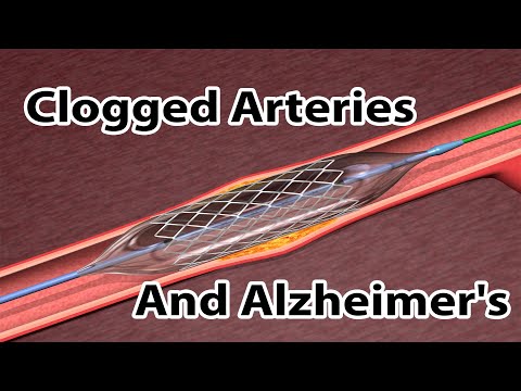 Clogged Arteries And Alzheimer's Makes Up 80% Of Dementia - By Author Steve Blake