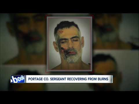 An outpouring of support for Portage Co. deputy badly burned by felony suspect