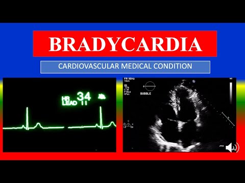 BRADYCARDIA - Definition, types, causes, pathophysiology, symptoms , diagnoses , medicine