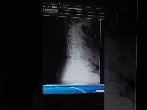 L spine ap & lat view x ray image complication swelling.