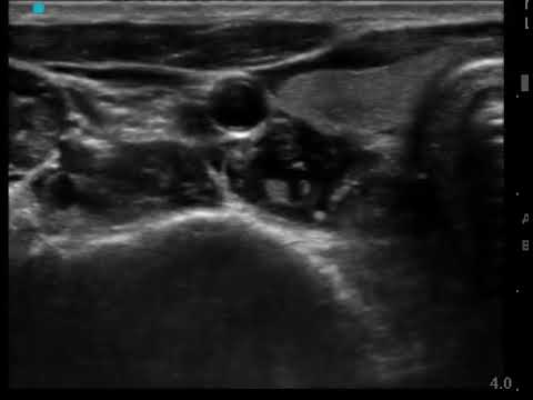 Ultrasound Guided Stellate Ganglion Block