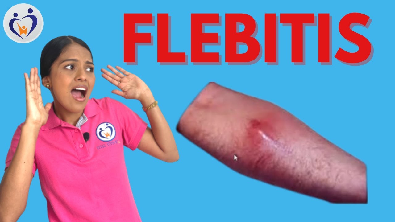 FLEBITIS