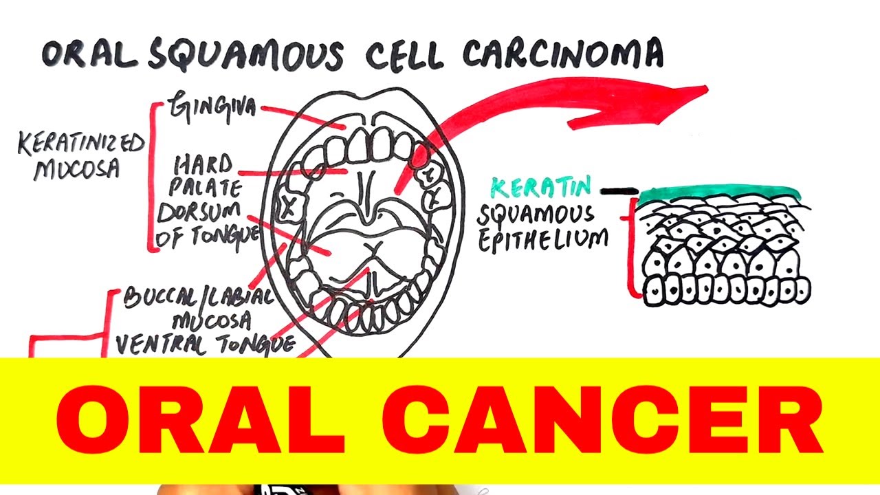 Oral Squamous Cell Carcinoma - Pathology, Etiology, Clinical features & Treatment
