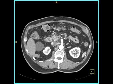 Abdomen: Pancreas: Pancreatic cancer invades portal vein: Axial CT shows mesenteric vessels