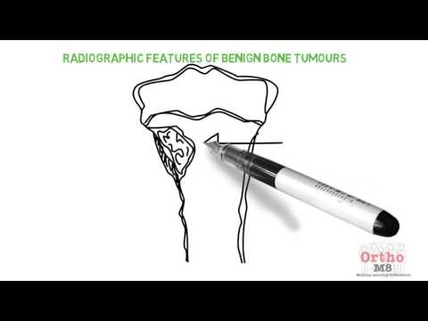 Radiographic features - Benign bone tumours