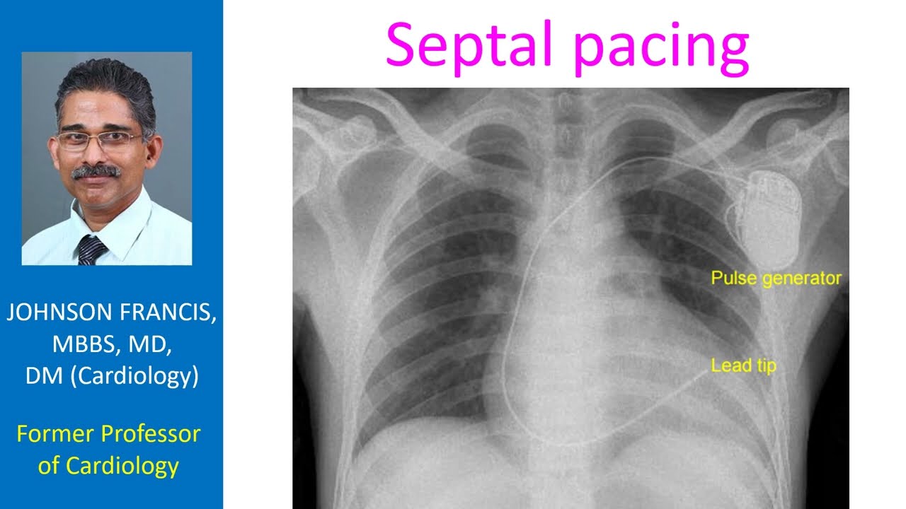 Septal pacing