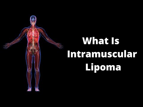 What Is Intramuscular Lipoma