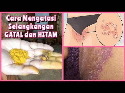 CARA MENGOBATI SELANGKANGAN GATAL | SELANGKANGAN GATAL DAN BERJAMUR - DENGAN KUNYIT