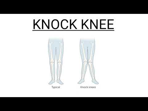 Postural Defects| Posture Part 1| B.Ed 2 Year #posturaldefects #posture