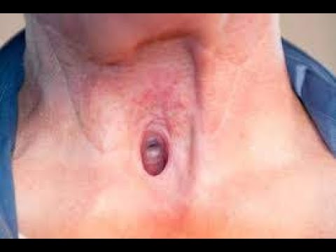 Laryngectomy CPT code - simplify medical coding