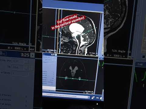 Mri csf flow Study #mri csf flow cerebral aqueduct